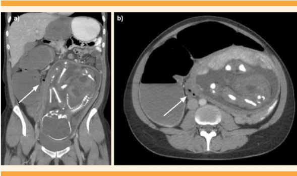 Vólvulo colónico recidivado en una mujer embarazada: tratamiento ...
