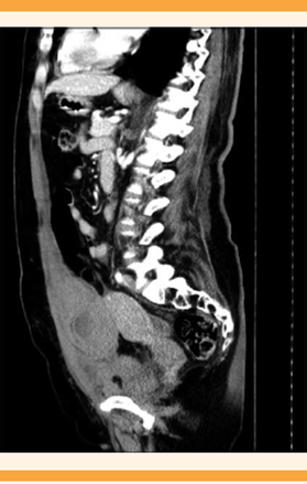 Hematoma de la vaina de los rectos como complicación de cirugía ...