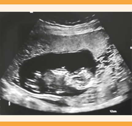 Embarazo gemelar con mola hidatiforme completa y feto vivo coexistente