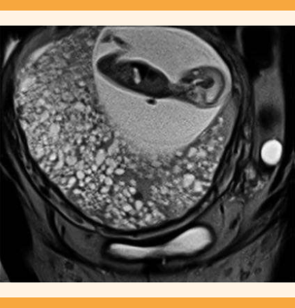 Embarazo gemelar con mola hidatiforme completa y feto vivo coexistente
