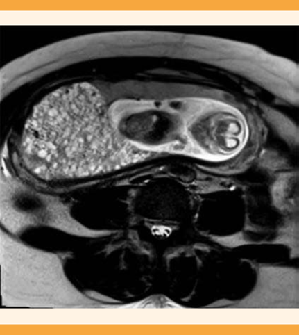 Embarazo gemelar con mola hidatiforme completa y feto vivo coexistente