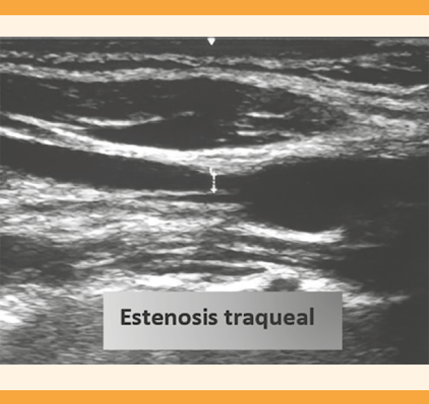 Tratamiento de la estenosis traqueal sintomática durante el embarazo ...