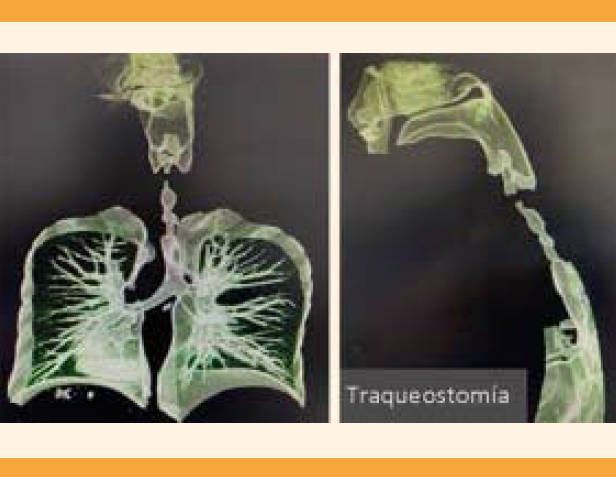 Tratamiento de la estenosis traqueal sintomática durante el embarazo ...