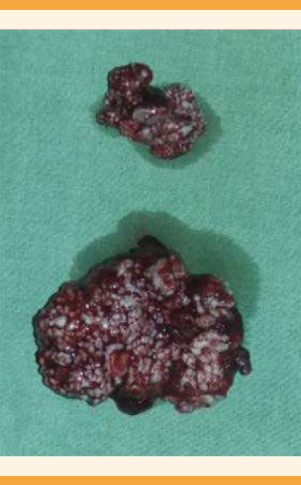 Resección de tumor de Buschke-Löwenstein en una mujer embarazada ...