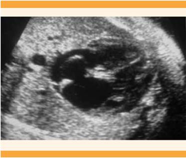 Diagnóstico prenatal de aneurisma del septo interauricular: reporte de ...