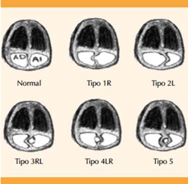 Diagnóstico prenatal de aneurisma del septo interauricular: reporte de ...