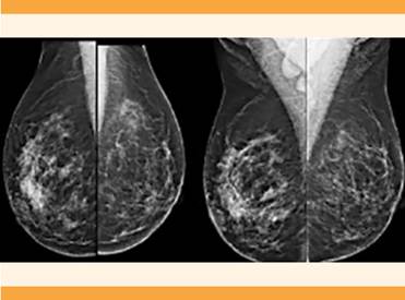 Mastitis granulomatosa: una simuladora de cáncer, un gran reto ...