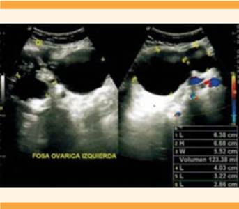 Tumor de colisión en el ovario, con fibrotecoma. Reporte de un caso