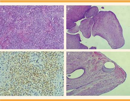 Tumor de colisión en el ovario, con fibrotecoma. Reporte de un caso