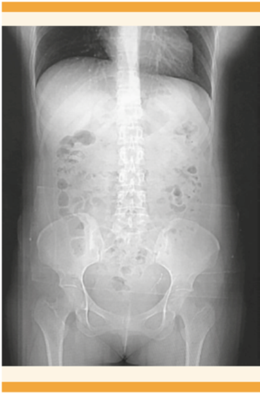 Perforación uterina completa por dispositivo intrauterino (DIU ...