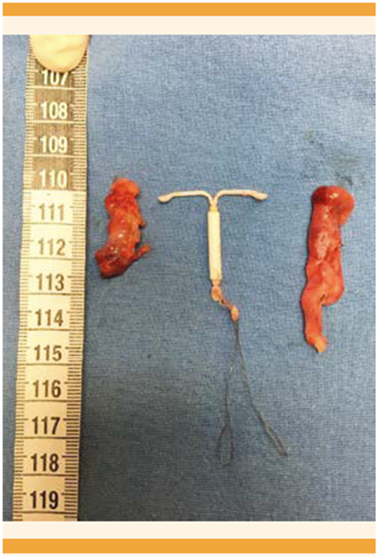 Perforación uterina completa por dispositivo intrauterino (DIU). Tratamiento laparoscópico ...