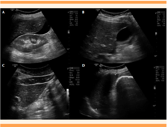 Hemoperitoneo espontáneo asociado con endometriosis en gestante de ...