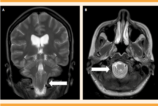 Malformación de Chiari tipo I en una embarazada. Reporte de caso