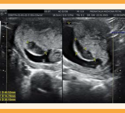 Significado clínico del diagnóstico prenatal de la protuberancia corial en el tamizaje del ...