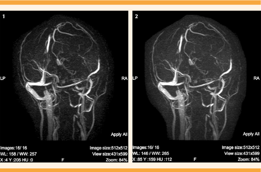 Trombosis de seno venoso en paciente en puerperio mediato. Reporte de caso