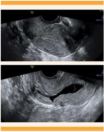 Sangrado uterino anormal: clasificación PALM-COEIN. Una actualización