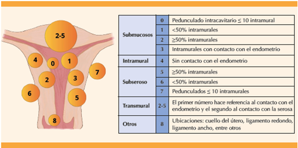 Sangrado uterino anormal: clasificación PALM-COEIN. Una actualización