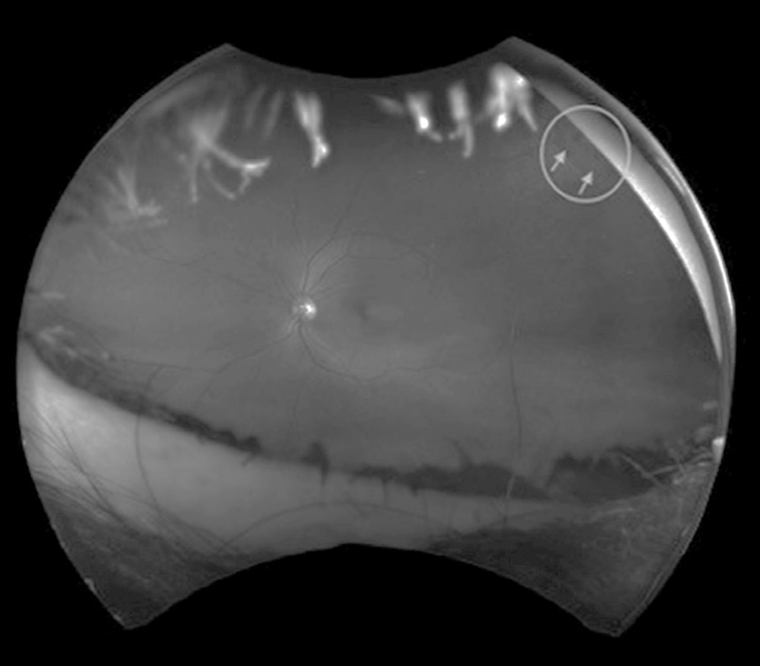 Cambios retinianos periféricos detectados mediante fotografía no ...