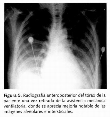 SÍNDROME DE EMBOLIA GRASA SECUNDARIA A INYECCIÓN INTRAMUSCULAR DE ...