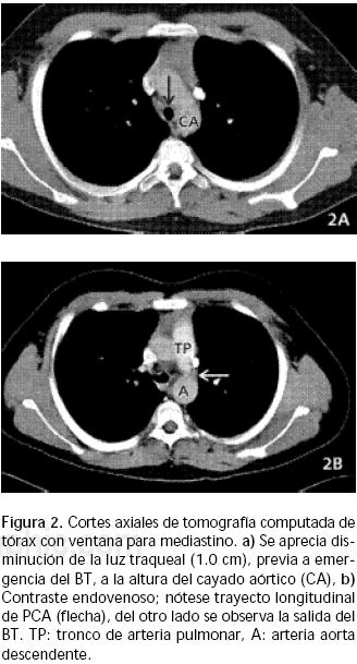 Anatomía Bronquial Por Tomografía Computarizada