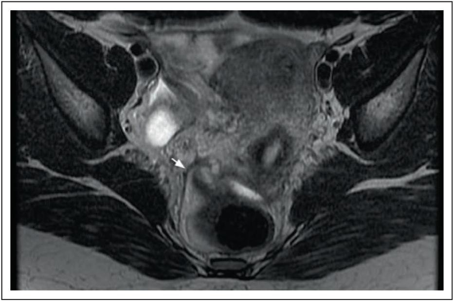 Endometriosis in magnetic resonance imaging: essentials for ...