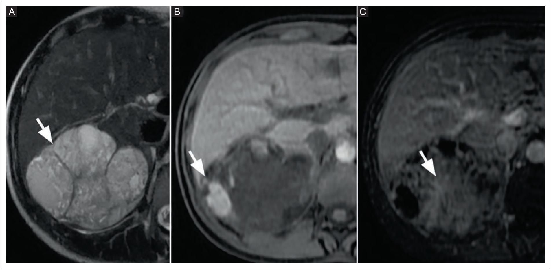 Endometriosis in magnetic resonance imaging: essentials for ...