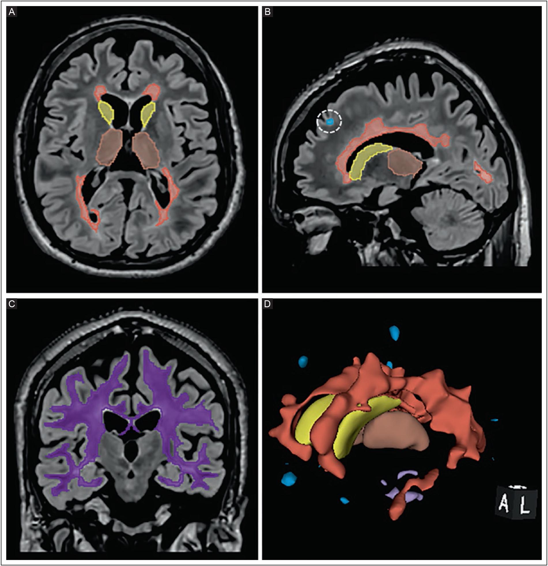Thalamic atrophy correlates with white matter lesion metrics in Mexican ...