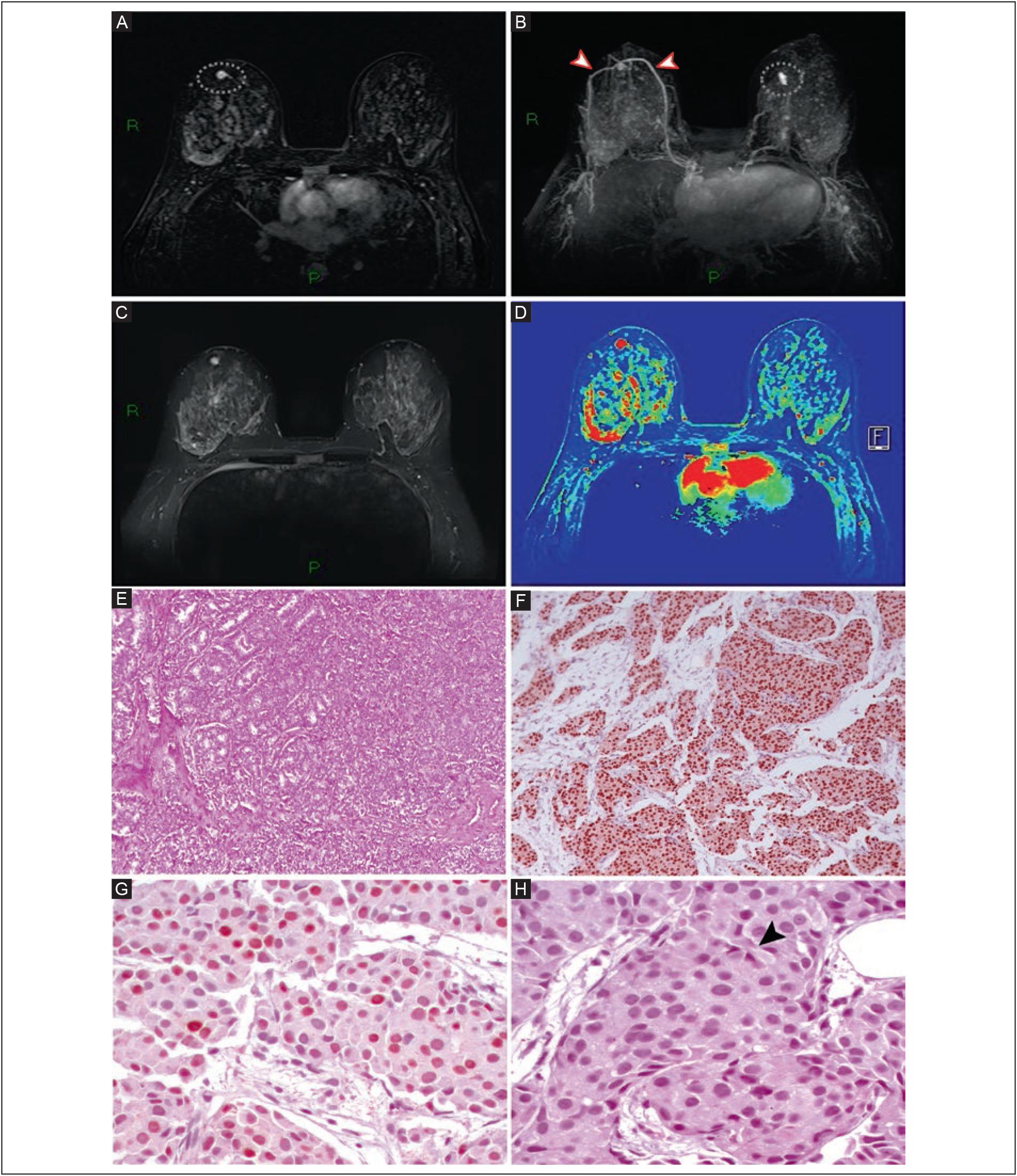 Vascular signs of Kaiser score on contrast-enhanced breast MRI improve ...