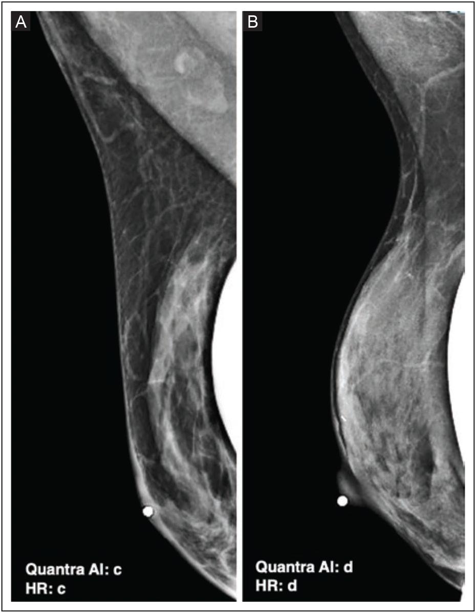 Comparison of the diagnostic performance of Quantra artificial intelligence software with an ...