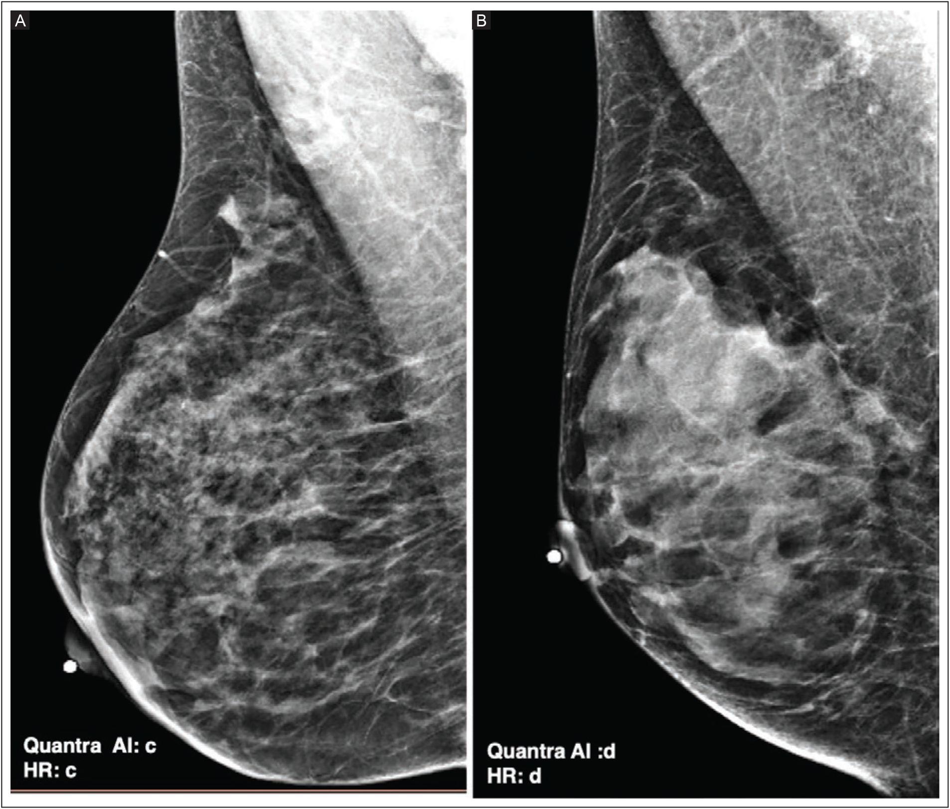 Comparison of the diagnostic performance of Quantra artificial intelligence software with an ...
