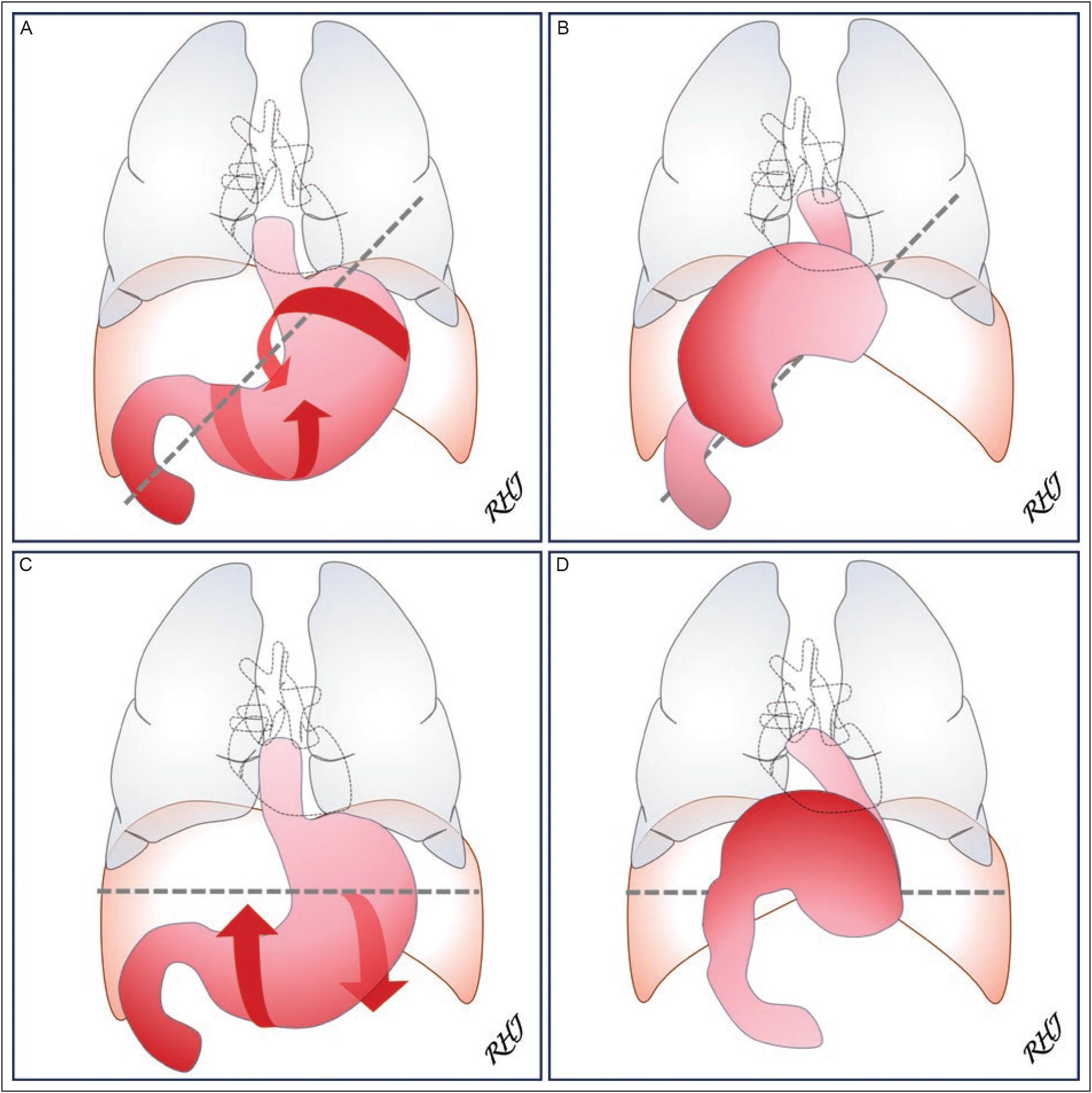 Quantification of an intrathoracic organoaxial gastric volvulus ...