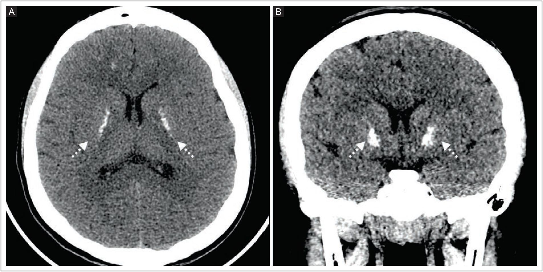 CT and MRI calcifications in the basal ganglia in primary ...