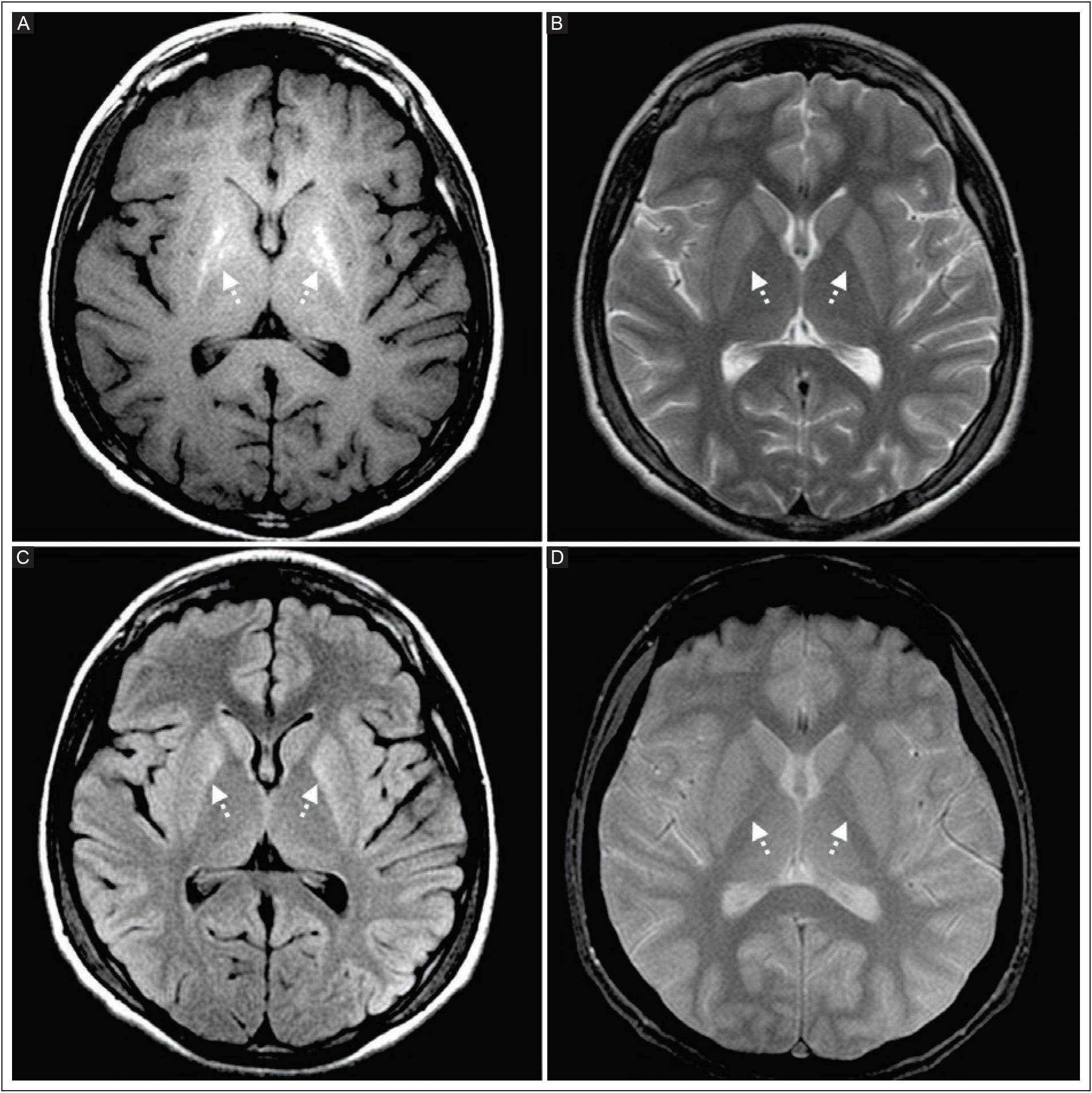 CT and MRI calcifications in the basal ganglia in primary ...