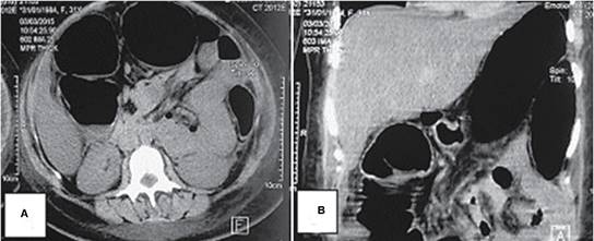 Megacolon tóxico por citomegalovirus en el embarazo: reporte de un caso ...