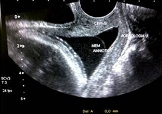 Medición de longitud cervical transvaginal