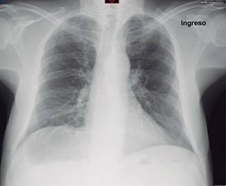 Desenlaces radiológicos del síndrome de insuficiencia respiratoria ...