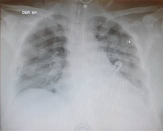 Rabdomiólisis en un caso de síndrome de insuficiencia respiratoria ...