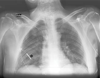 Neumotórax a tensión secundario a colocación de sonda enteral: reporte ...