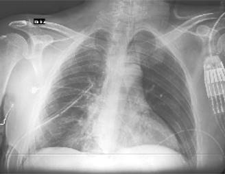 Neumotórax a tensión secundario a colocación de sonda enteral: reporte ...