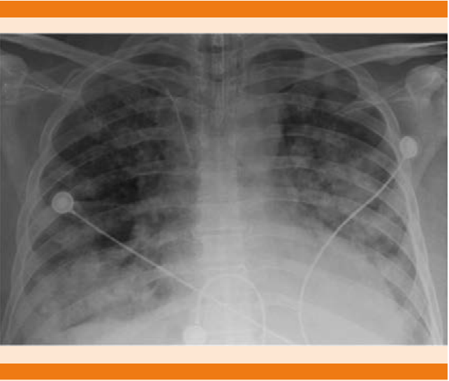 Granulomatosis con poliangitis, granulomatosis de Wegener