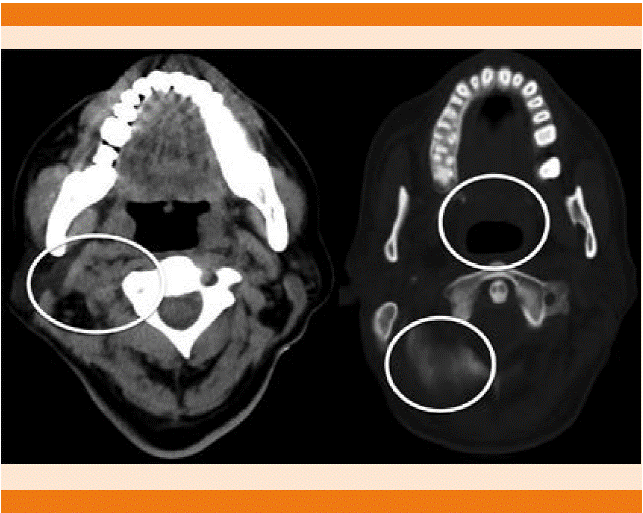 Granulomatosis con poliangitis, granulomatosis de Wegener