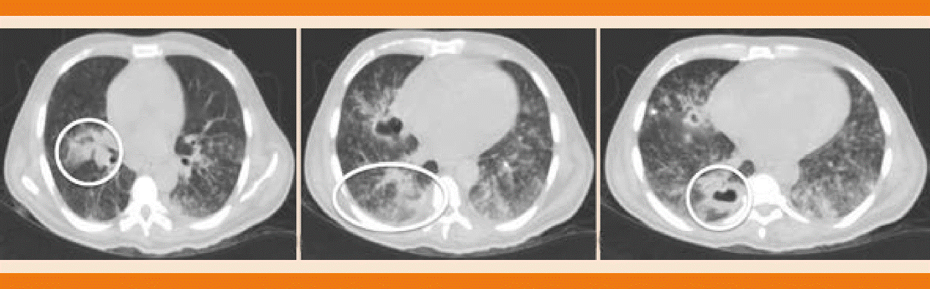 Granulomatosis con poliangitis, granulomatosis de Wegener