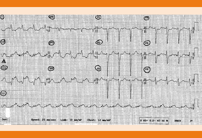 Electrocardiograma Ecg En Infarto De Miocardio Iam Infarto Agudo Al