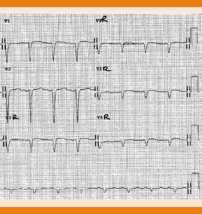 Electrocardiograma De Infarto De Miocardio Lateral