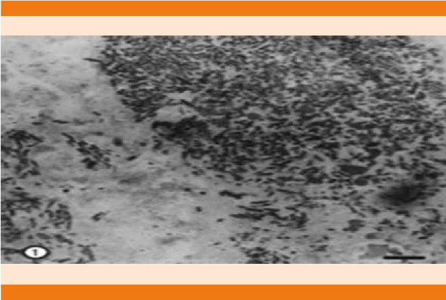 Mionecrosis fulminante metastásica por Aeromonas caviae