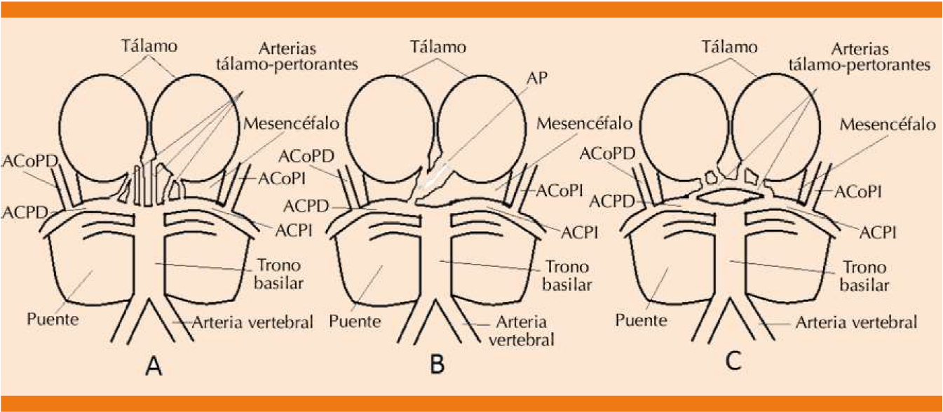 Infarto talámico bilateral secundario a oclusión de la arteria de Percherón