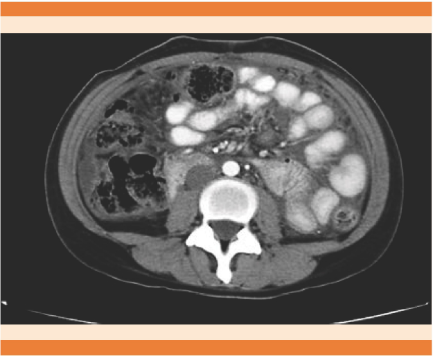 Tuberculosis peritoneal
