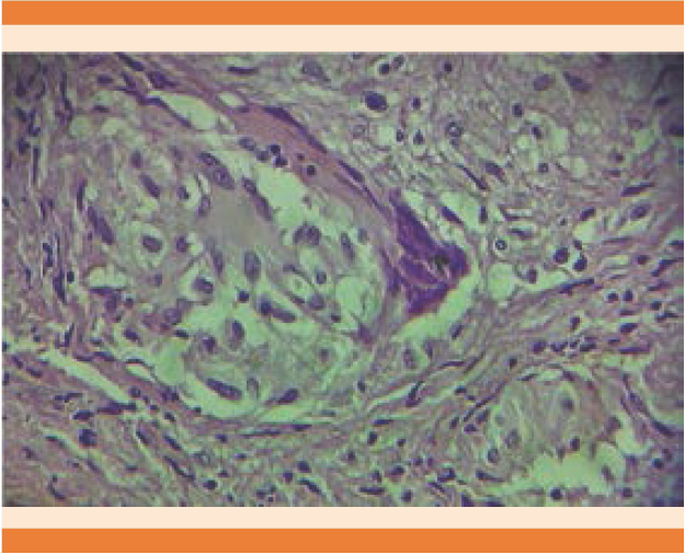 Tuberculosis peritoneal