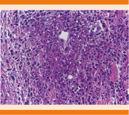 Púrpura de Henoch-Schönlein como manifestación inicial de mieloma múltiple