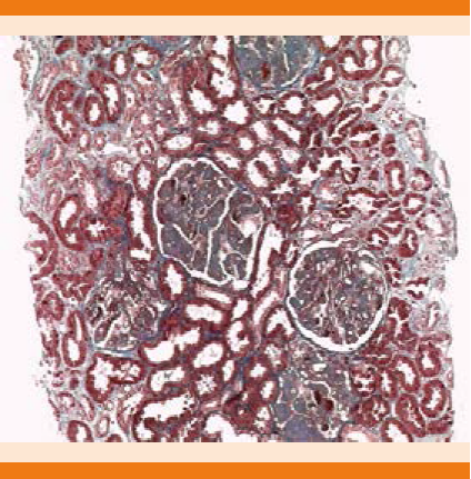 Púrpura de Henoch-Schönlein como manifestación inicial de mieloma múltiple